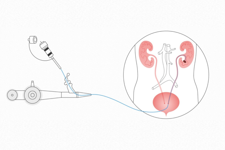 Ureteroscopy – Dr. Anand Arumugam